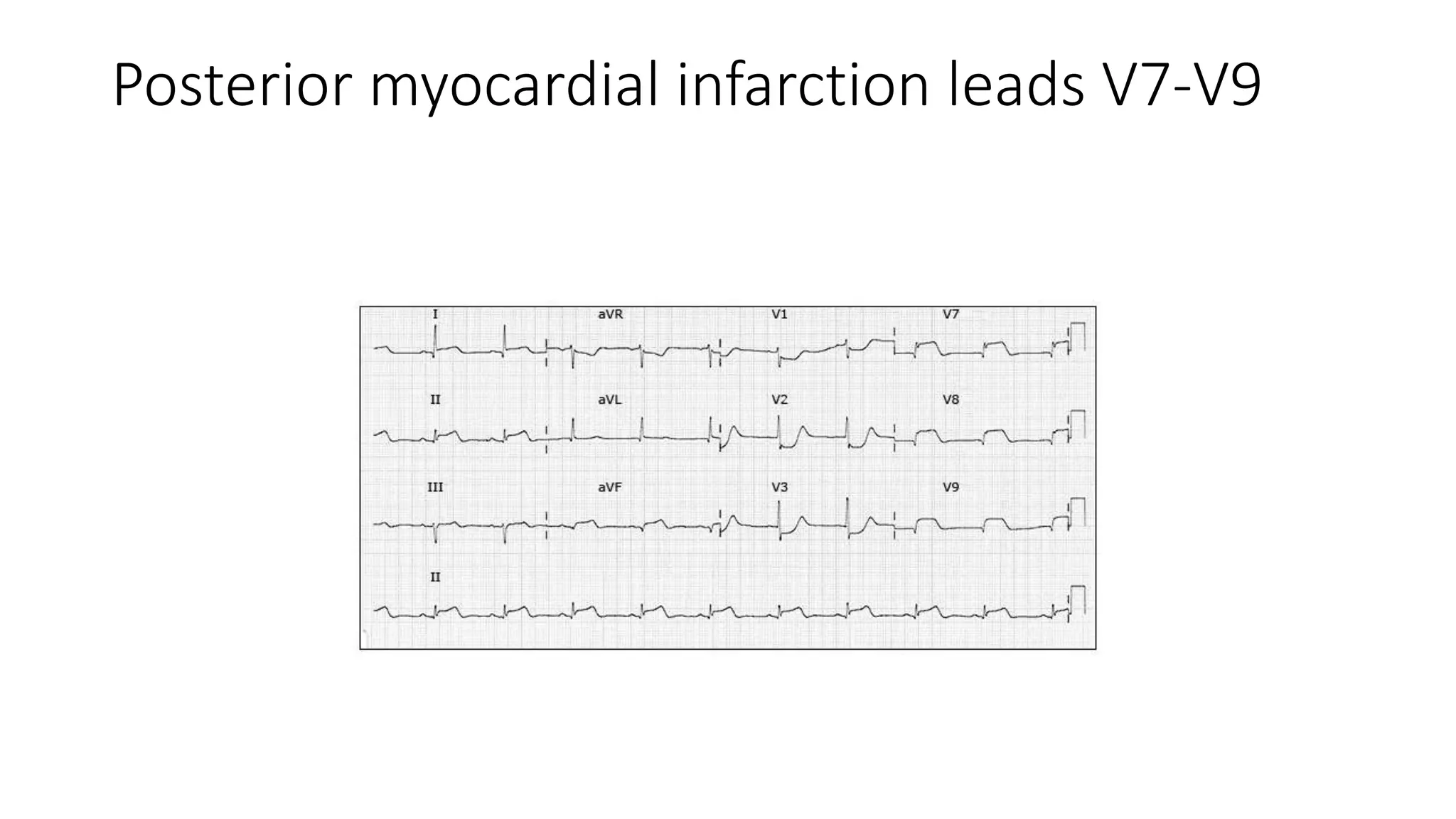 Electrocardiogram in myocardial infarction | PPTX