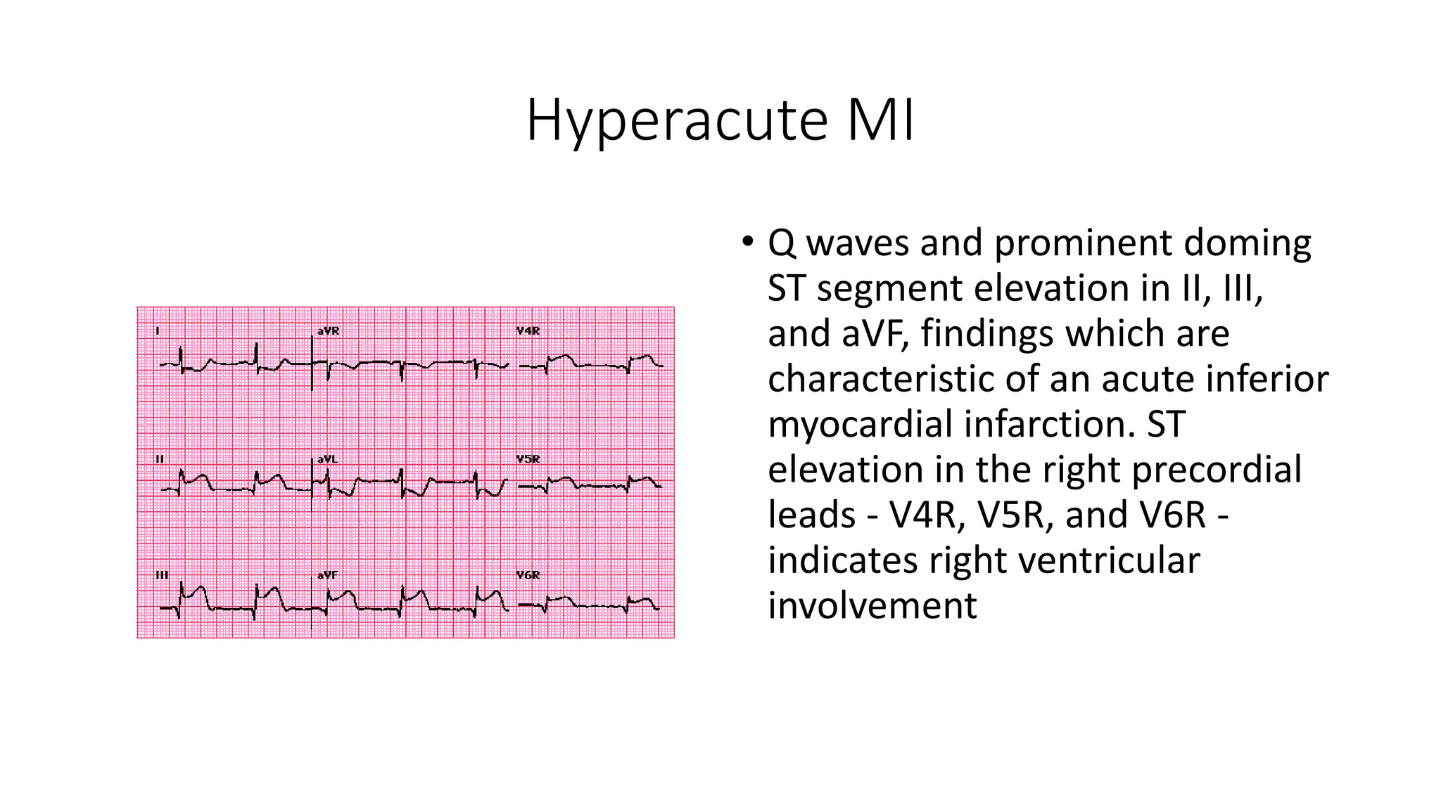 Electrocardiogram in myocardial infarction | PPTX