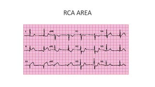 Electrocardiogram in myocardial infarction | PPTX