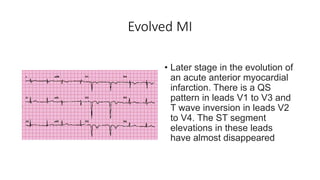 Electrocardiogram in myocardial infarction | PPTX