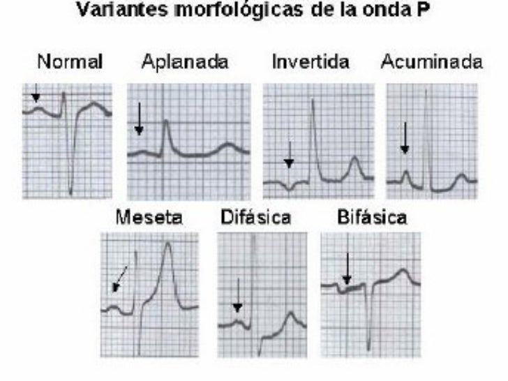 Electrocardiograma