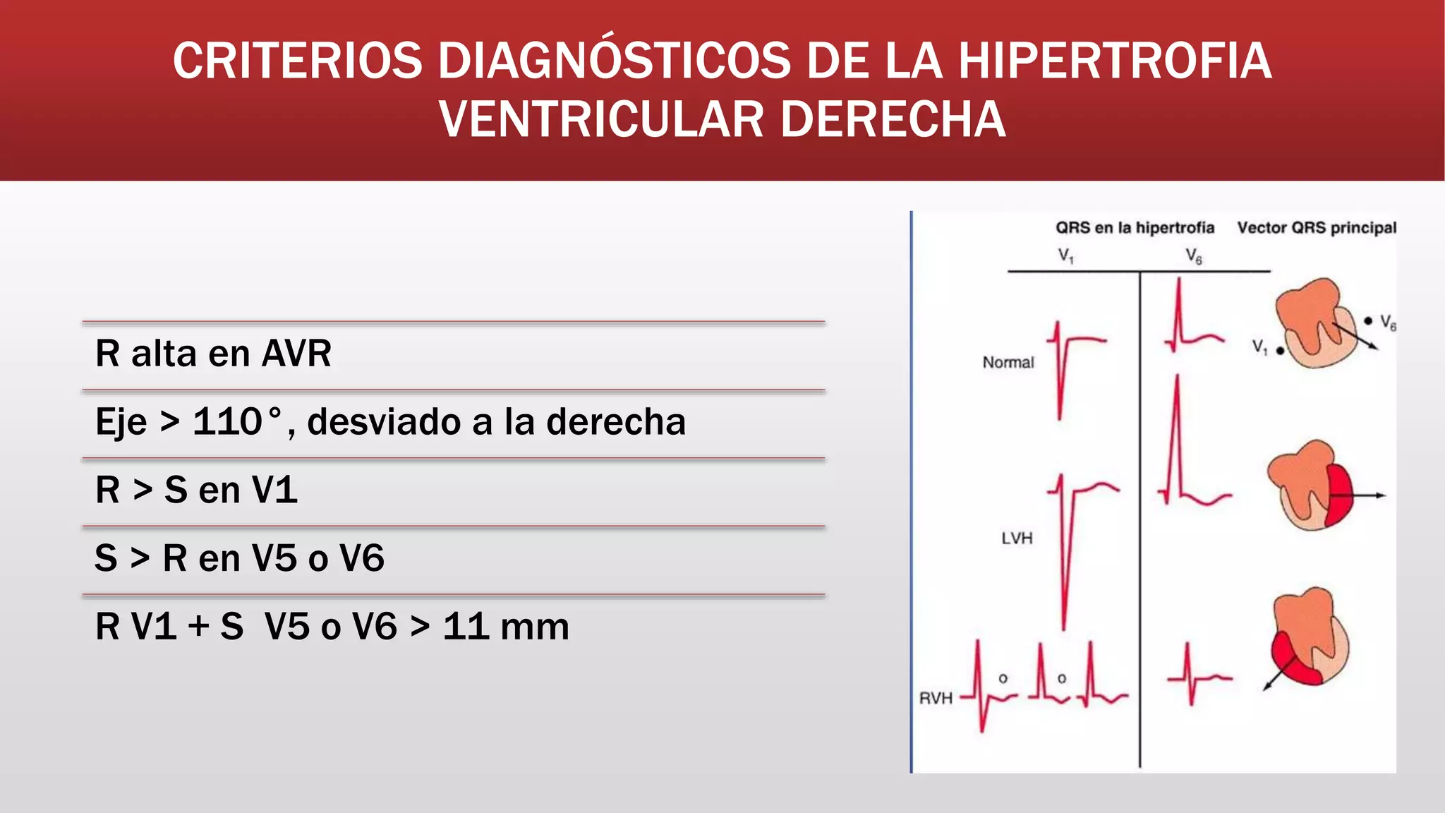 Electrocardiograma ( HIPERTROFIA ) | PPTX