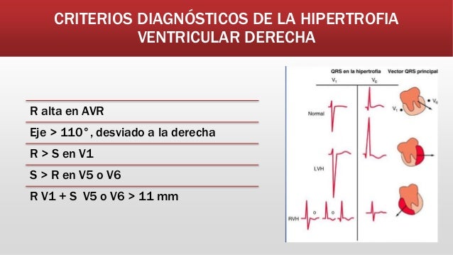 Electrocardiograma ( HIPERTROFIA )