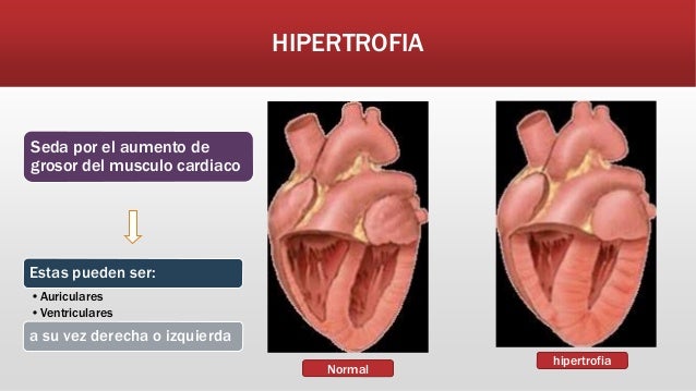 Electrocardiograma ( HIPERTROFIA )