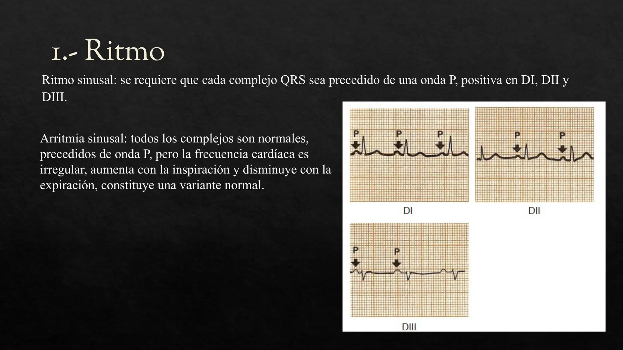 Electrocardiograma, corazón, ondas, complejos | PDF