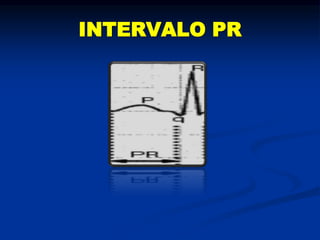 Electrocardiograma | PPTX