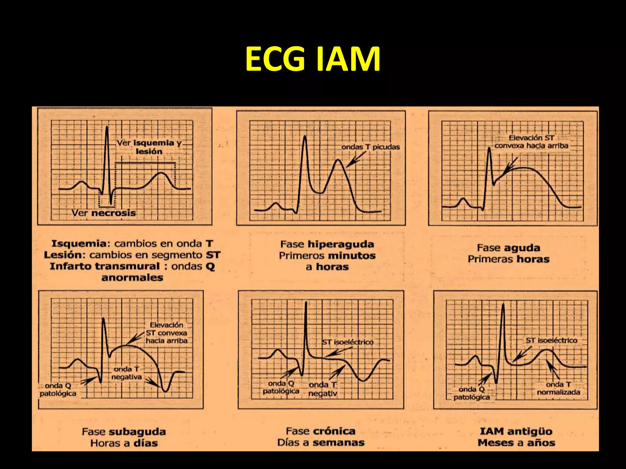 Electrocardiograma en IAM 2015 | PPTX