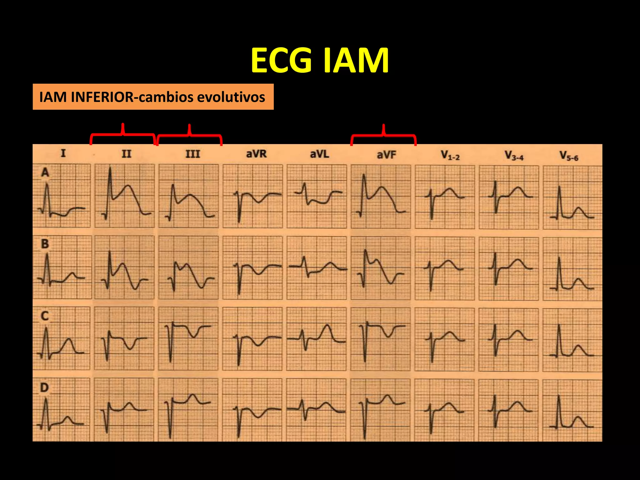 Electrocardiograma en IAM 2015 | PPTX