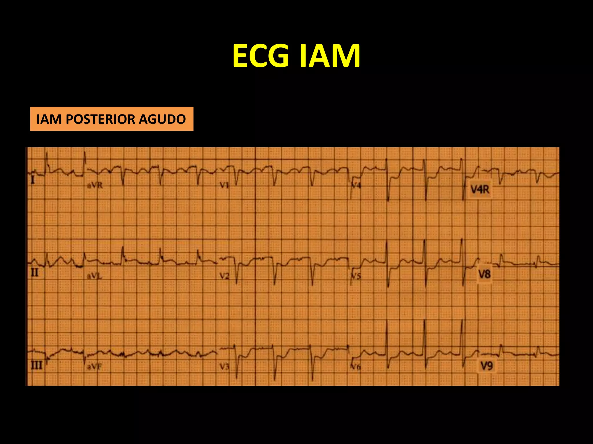 Electrocardiograma en IAM 2015 | PPTX