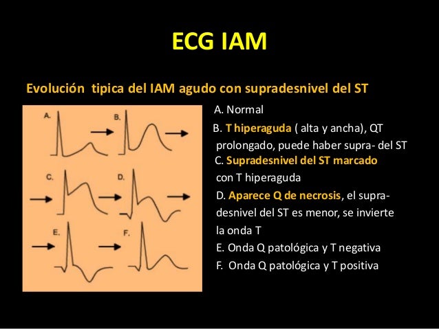 Electrocardiograma Ecg En Infarto De Miocardio Iam