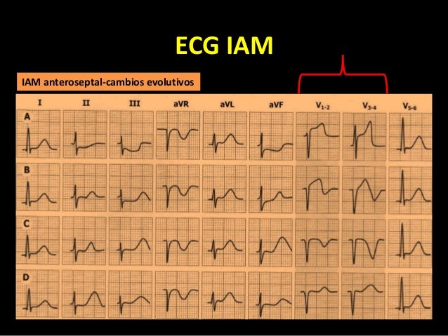 Electrocardiograma en iam 2015