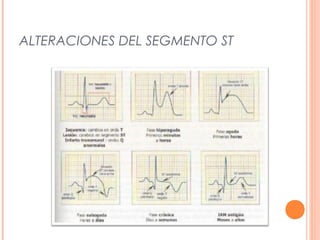 Electrocardiograma (ECG) básico | PPT