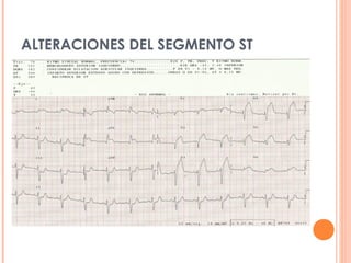 Electrocardiograma (ECG) básico | PPT