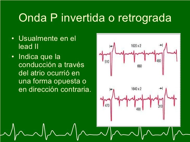 Electrocardiograma y arritmia