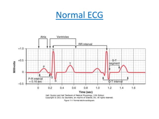 Electrocardiogram (ECG) | PPTX | Heart and Cardiovascular Diseases ...