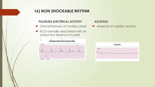 ELECTRO CARDIOGRAM (ECG) FINDING FOR NURSES | PPTX