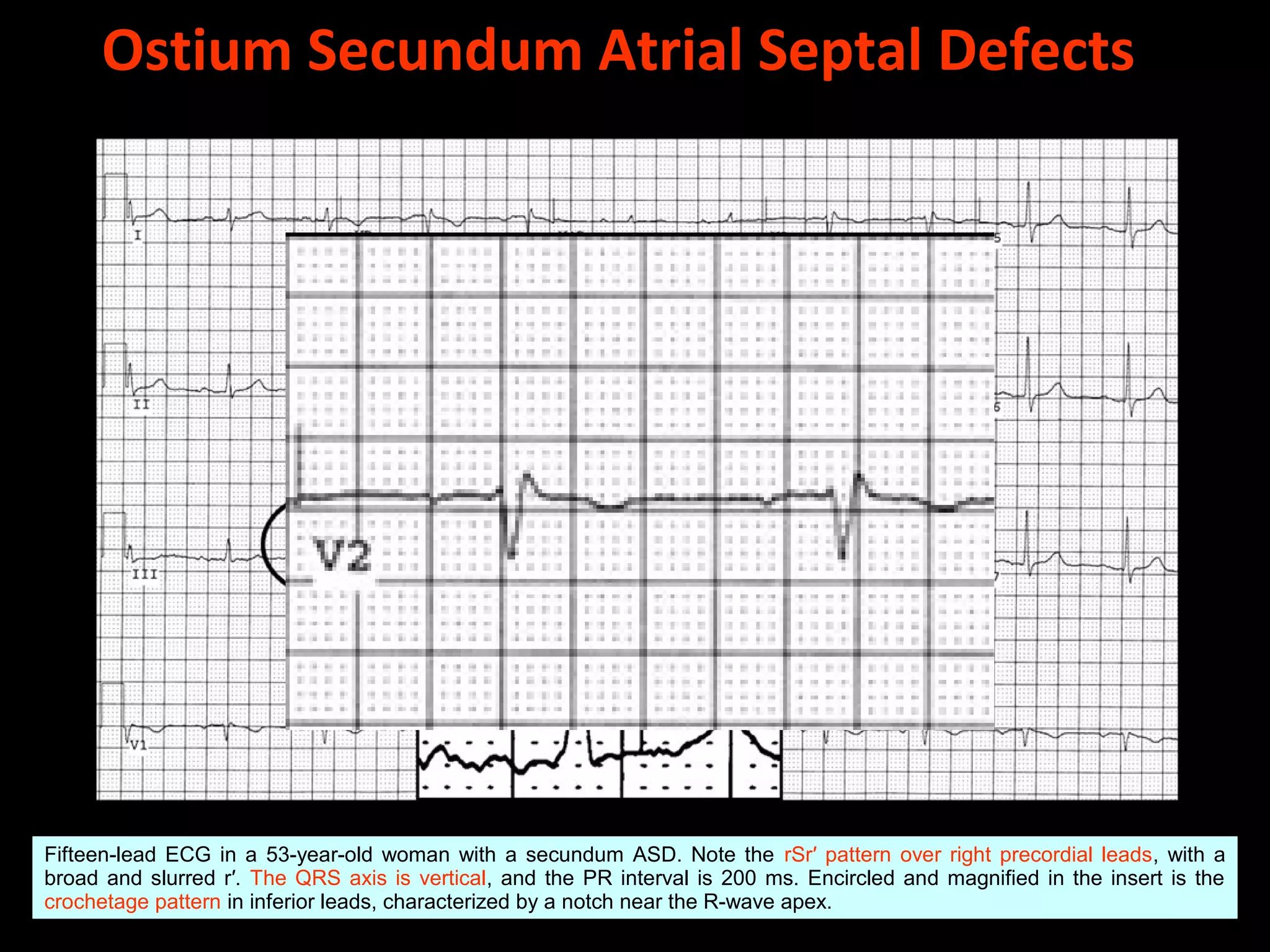 Electrocardiography in Adult Congenital Heart Diseases | PPT