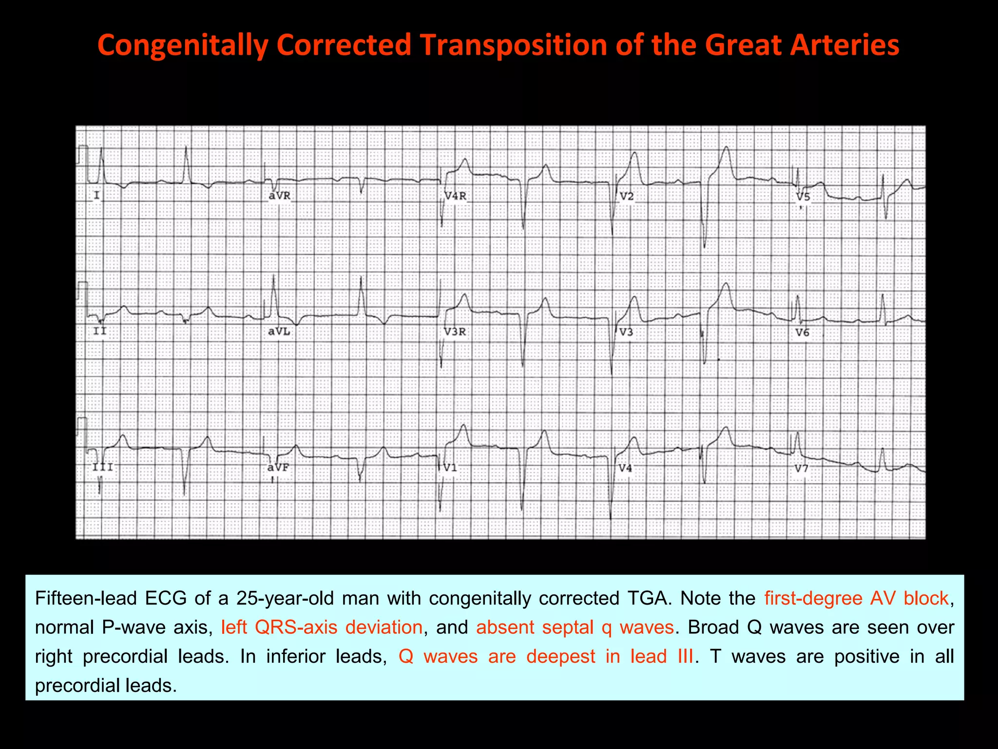 Electrocardiography in Adult Congenital Heart Diseases | PPT