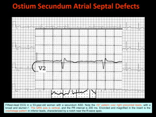 Electrocardiography in Adult Congenital Heart Diseases | PPT