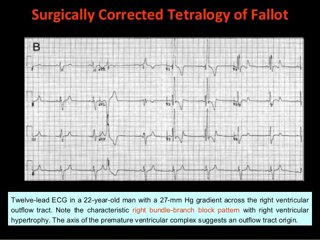 Electrocardiography in Adult Congenital Heart Diseases