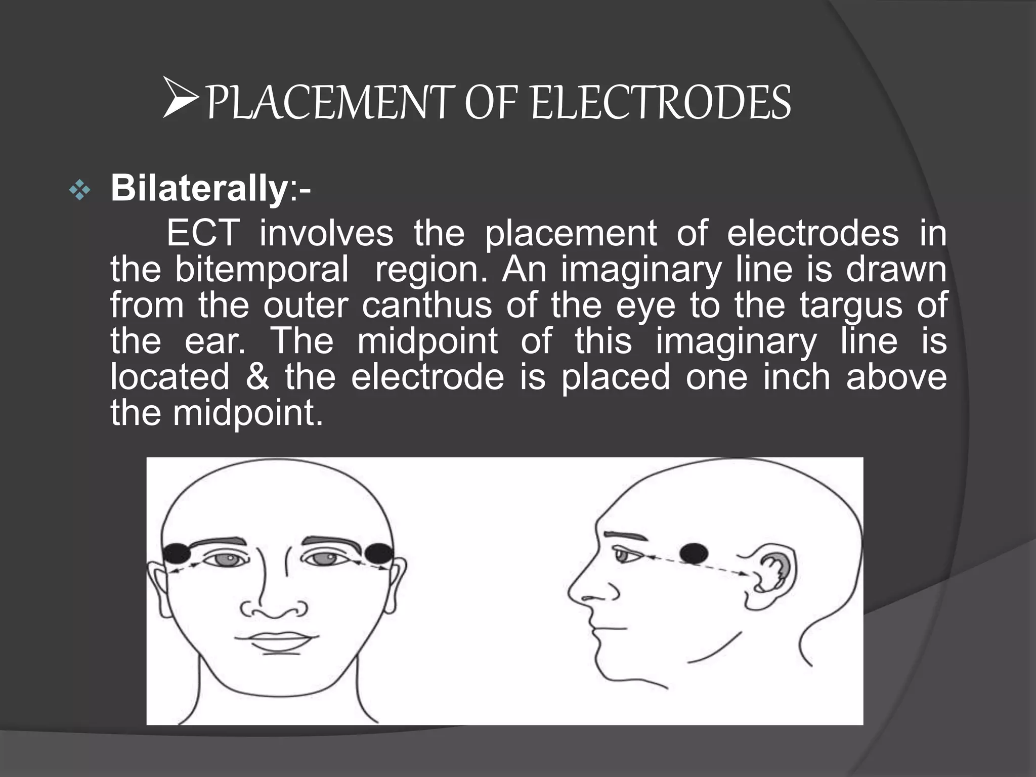 Electro convulsive therapy | PPTX