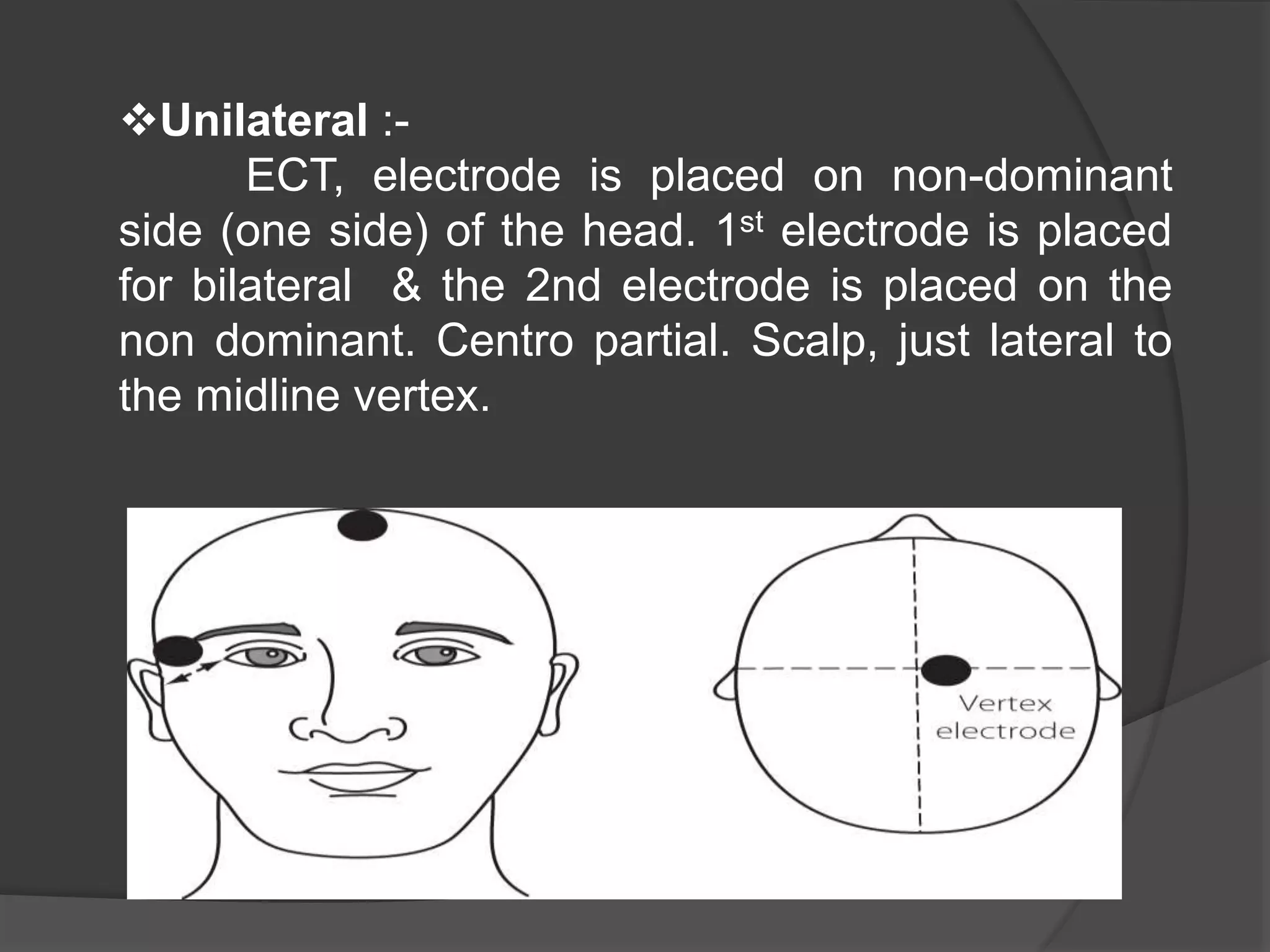 Electro convulsive therapy | PPTX