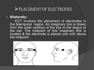 Electro convulsive therapy | PPTX