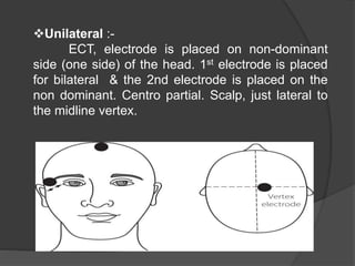 Electro convulsive therapy | PPTX