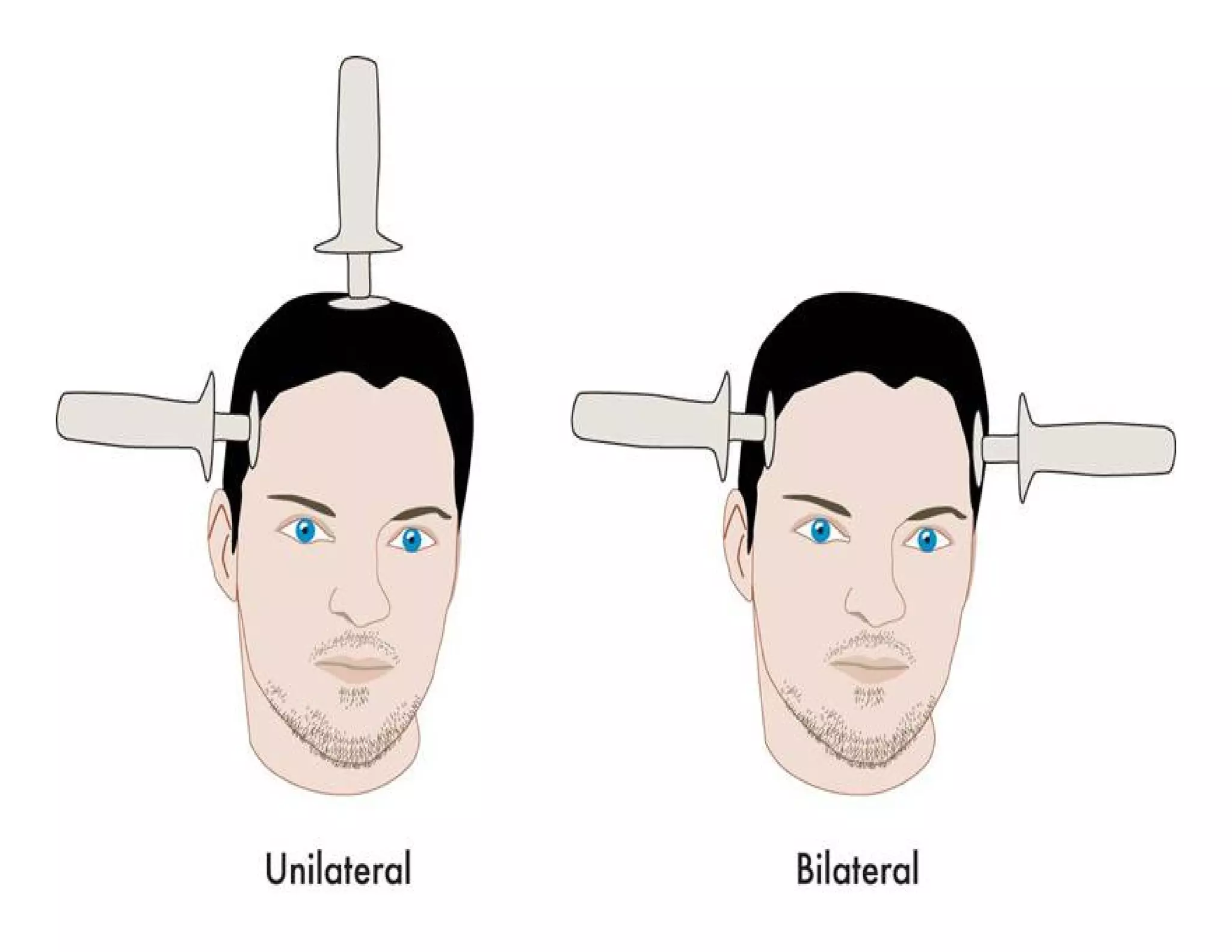 Electro convulsive therapy (ECT) | PDF