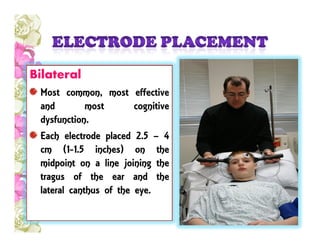 Electro convulsive therapy (ECT) | PDF