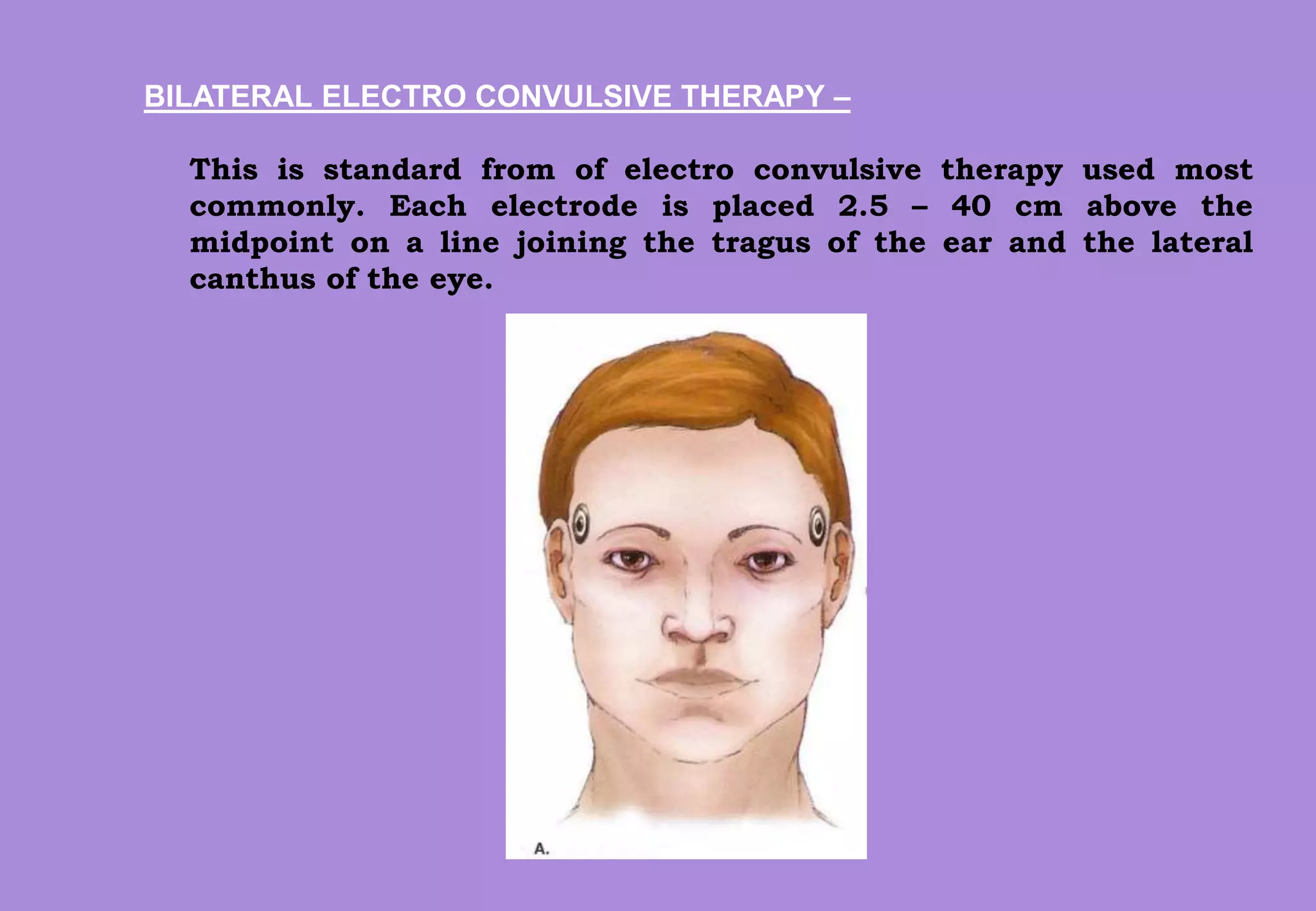Electro convulsive therapy final. ppt | PPT