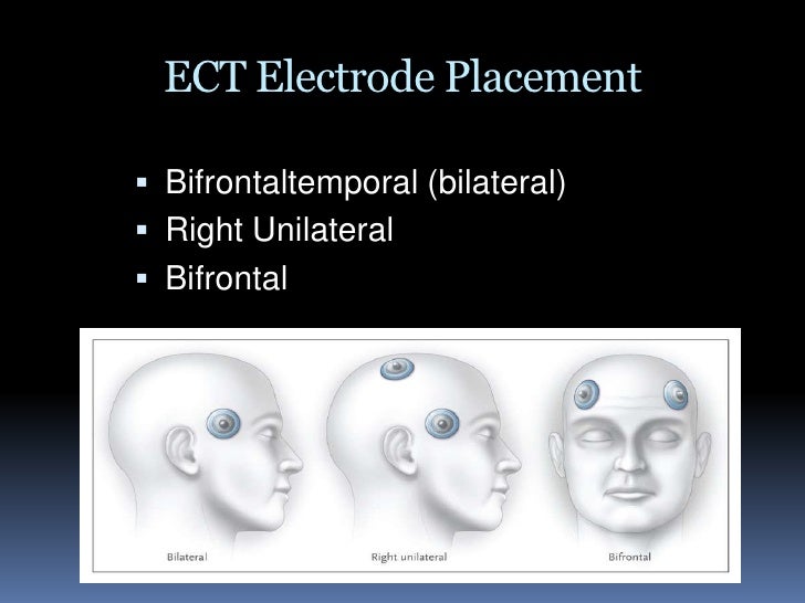 Electroconvulsiv Therapy Presentation