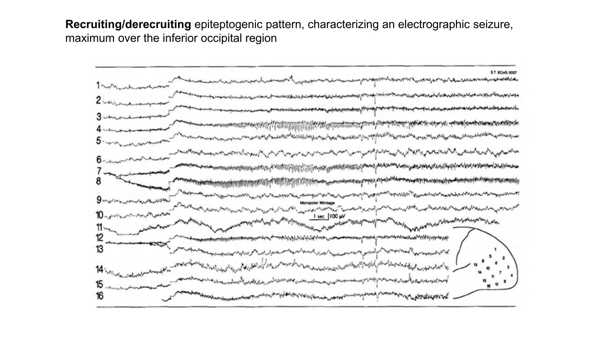 Electrocorticography | PPTX