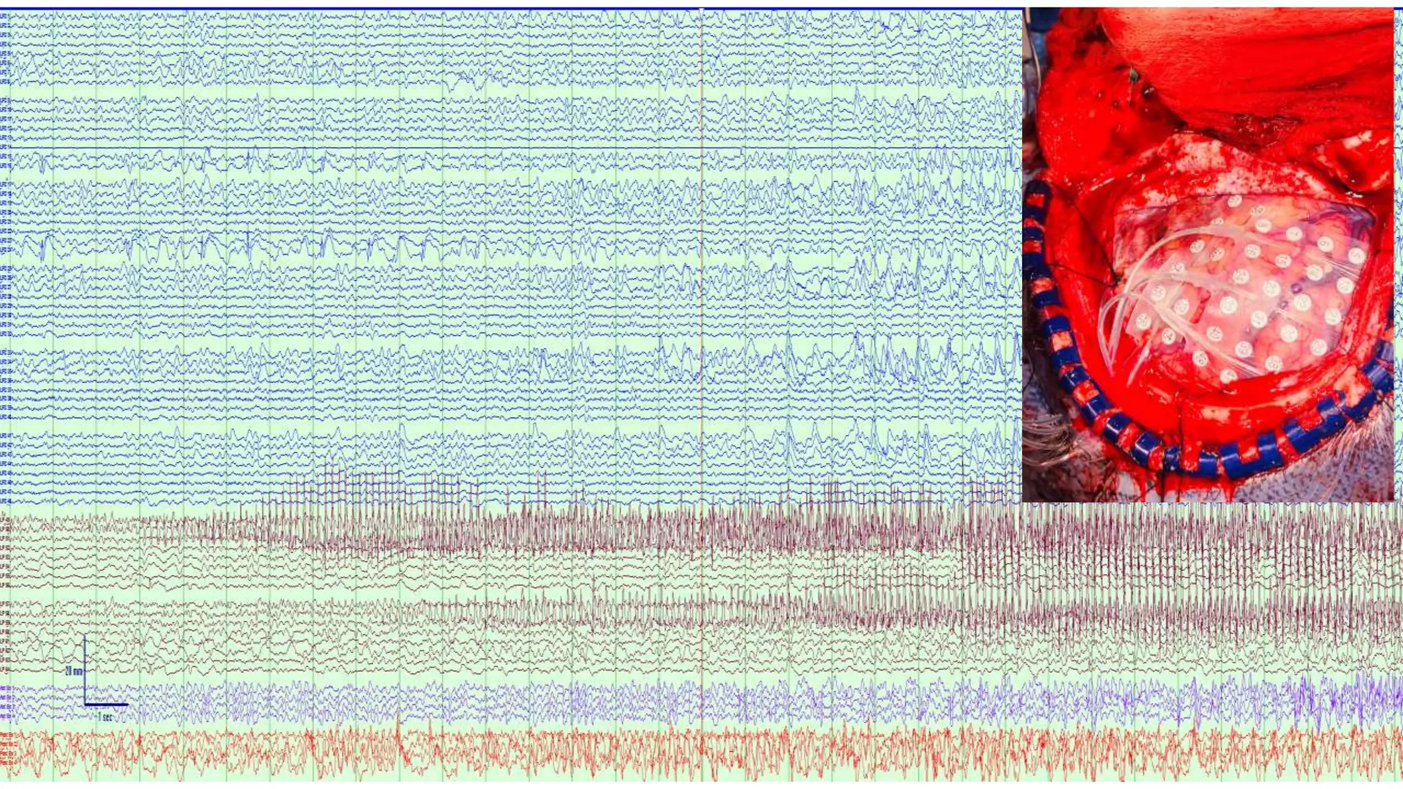 Electrocorticography | PPTX
