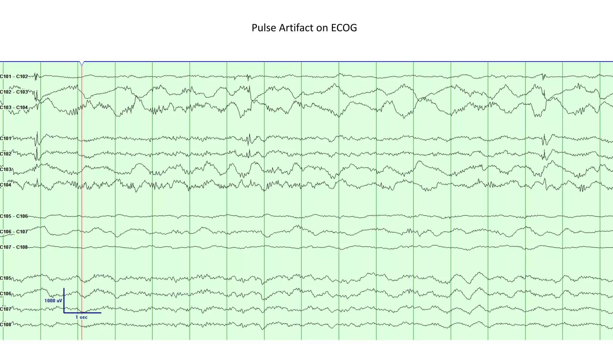 Electrocorticography | PPTX