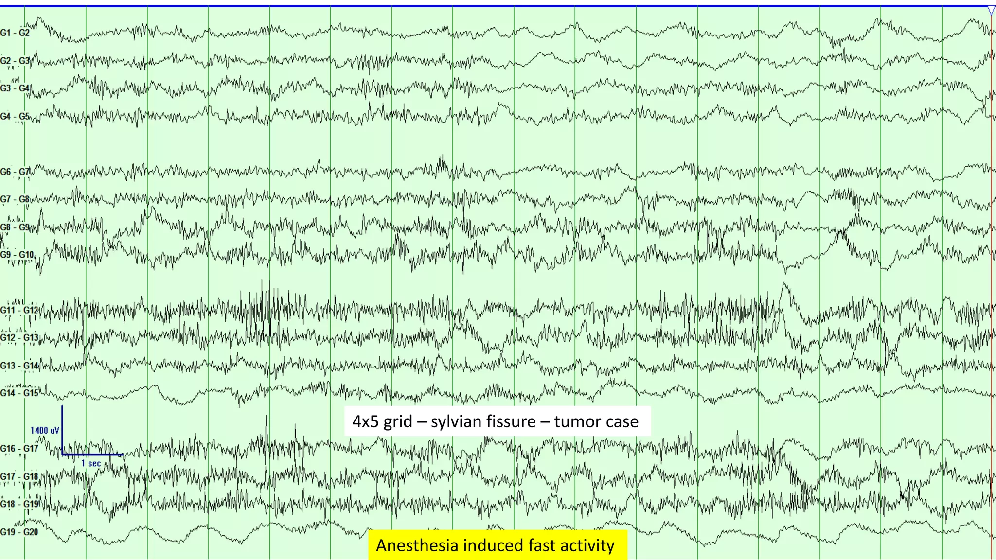 Electrocorticography | PPTX