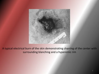 Electrocution rs | PPTX