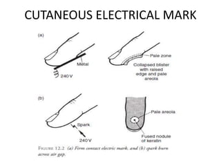 Electrocution (suicidal) | PPTX