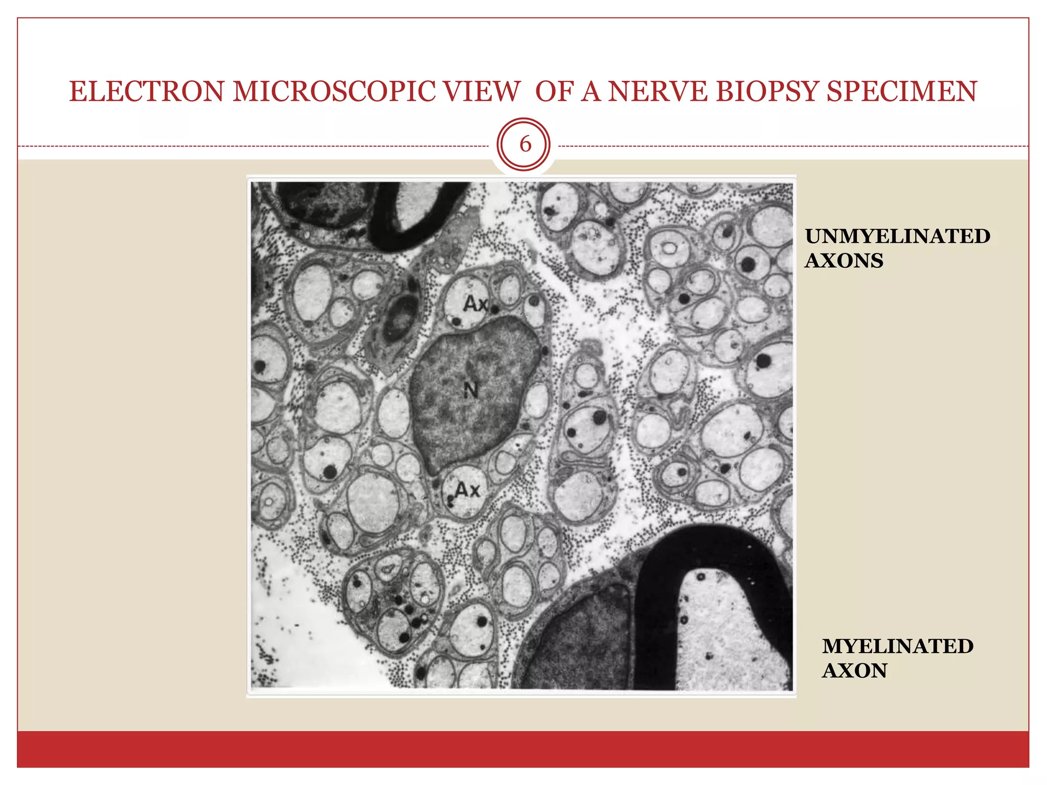 Electrodiagnostic approach to peripheral neuropathy | PPTX