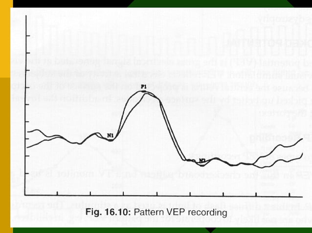 Electrodiagnostic Tests in Ophthalmology | PPT | Eye and Vision ...