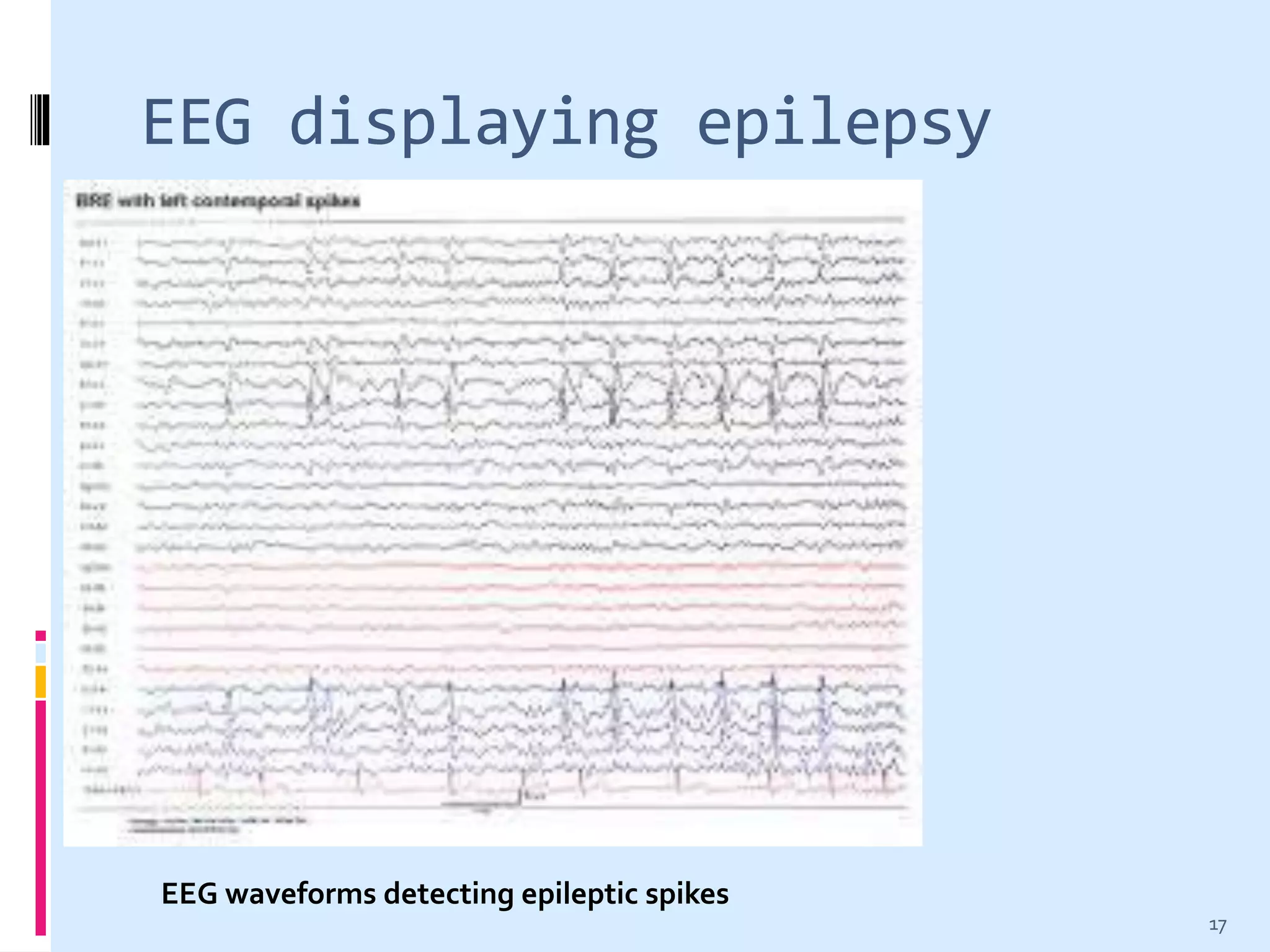 Electroencephalogram(EEG) | PPTX
