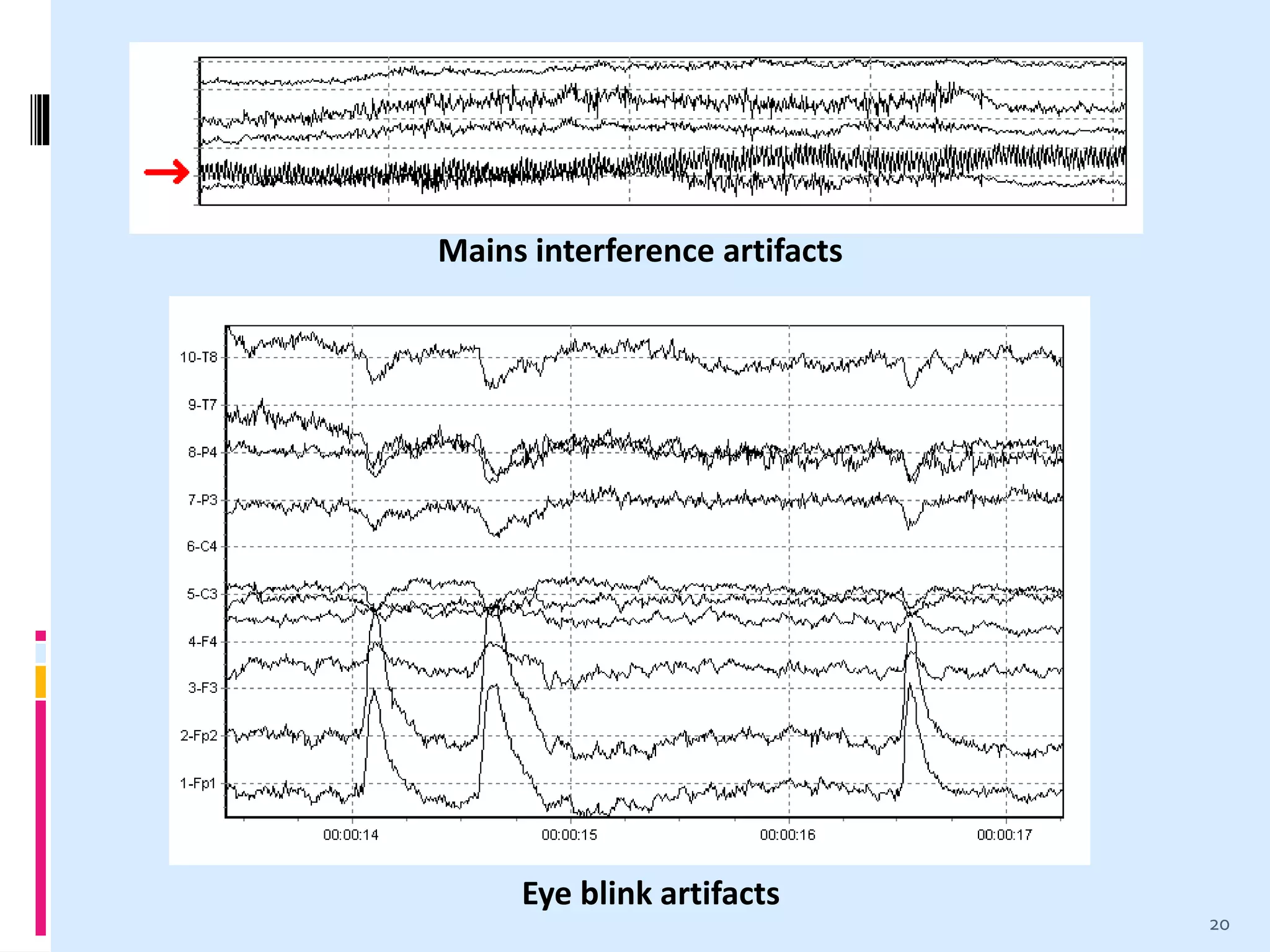 Electroencephalogram(EEG) | PPTX