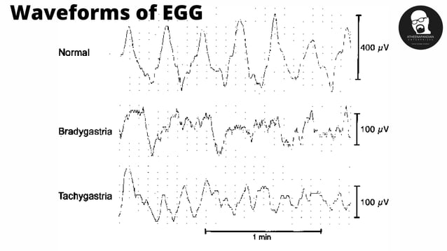 Electrogastrogram basics | PDF | Digestive Disorders | Diseases and ...
