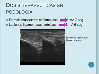Electrolisis percutánea intratisular (epi) | PPTX