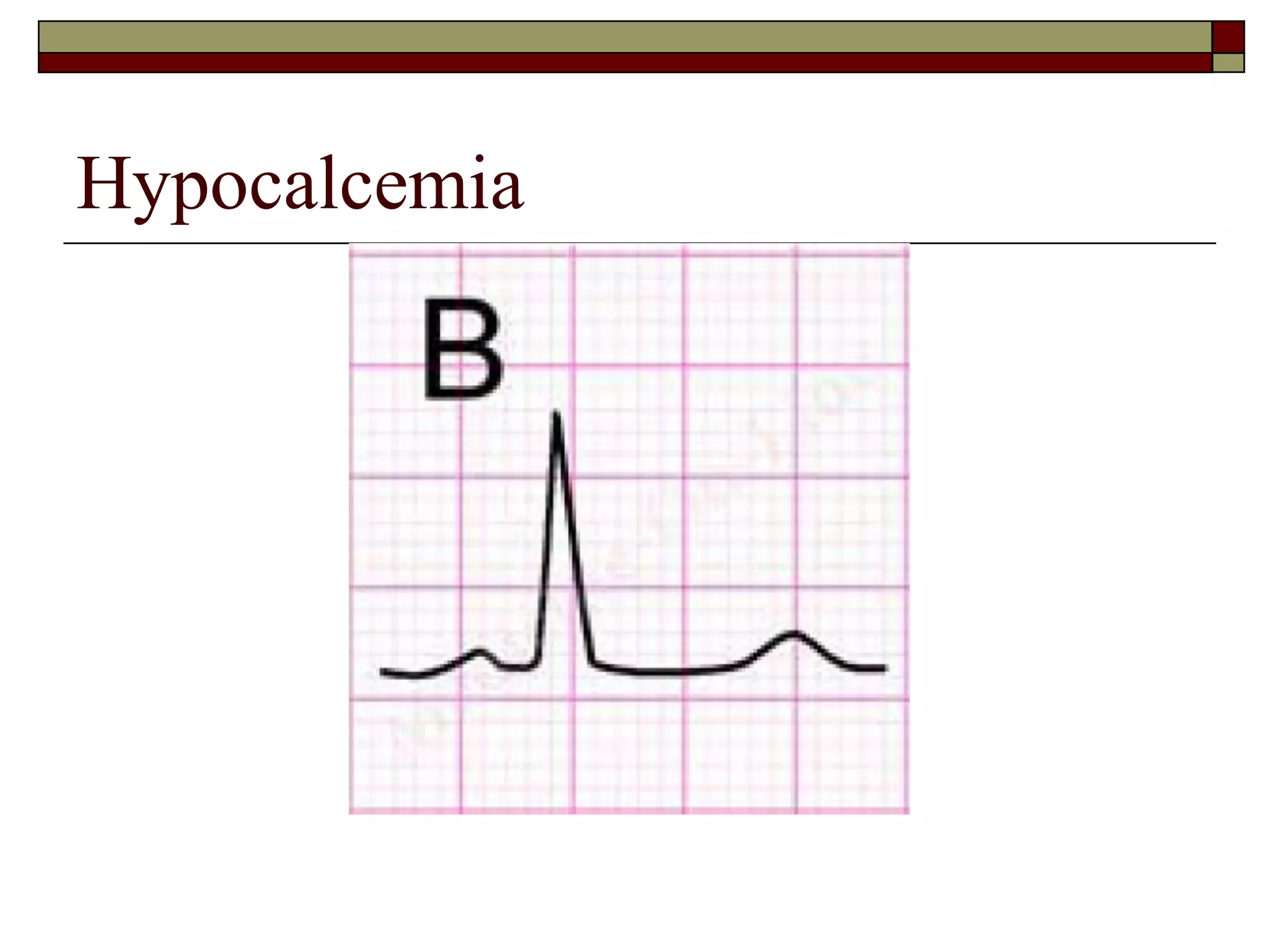 Electrolyte Imbalance and EKG Changes | PPT