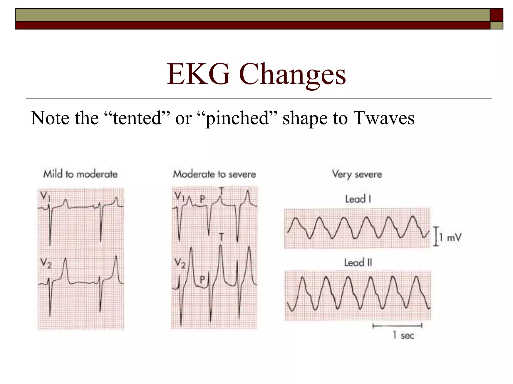 Electrolyte Imbalance and EKG Changes | PPT