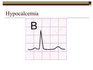 Electrolyte Imbalance and EKG Changes | PPT