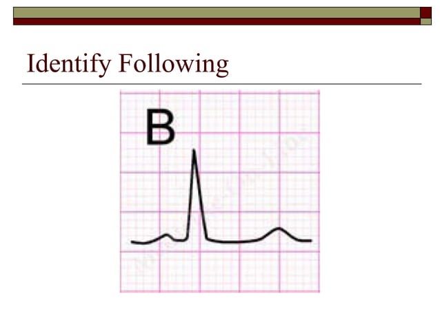 Electrolyte Imbalance and EKG Changes | PPT