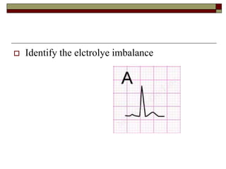 Electrolyte Imbalance and EKG Changes | PPT