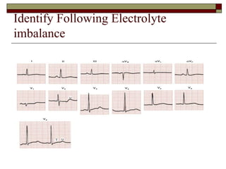Electrolyte Imbalance and EKG Changes | PPT